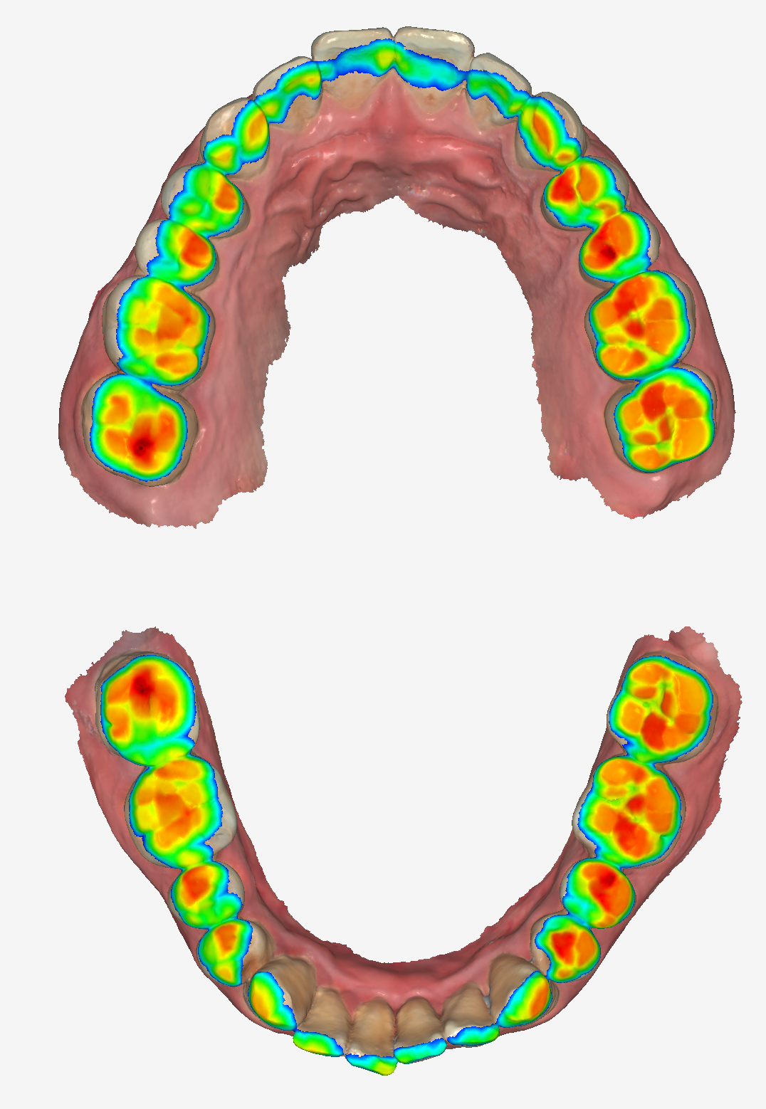 Occlusal distance | Runyes Intraoral Scanner System